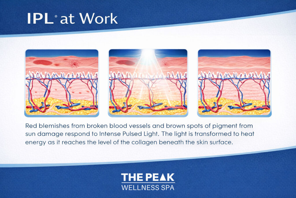 IPL Laser Treatment in Scottsdale | Alma Harmony XL